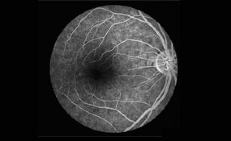 Retinal Image Enhancement using Super Resolution via Sparse ...