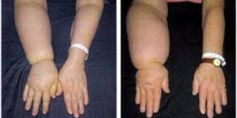 Lymphedema Characterization Using Segmental Bio-Impedance Signals and ...