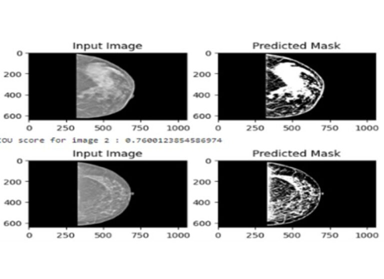 Segmentation Of Breast Tissues And Classification Of Breast Based On Breast Tissue Density